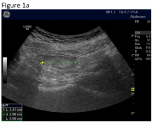 Epiploic Appendagitis or Localised Omental Infarct? [May 2018] – EFSUMB