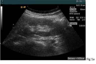 Fibromuscular dysplasia of the right renal artery [Dec 2017] – EFSUMB