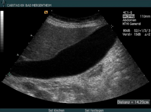 (Ch:19) Ultrasound of the gallbladder and hepatobiliary system – EFSUMB