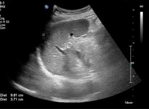 (Ch:25) Ultrasound of the Spleen – EFSUMB