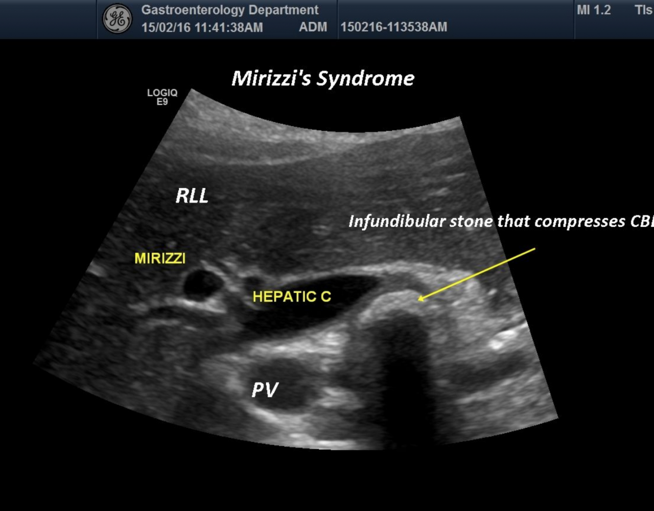 Gallbladder and Bile Ducts – EFSUMB