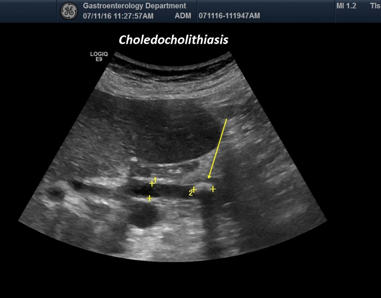 Gallstones in Bile Ducts – EFSUMB