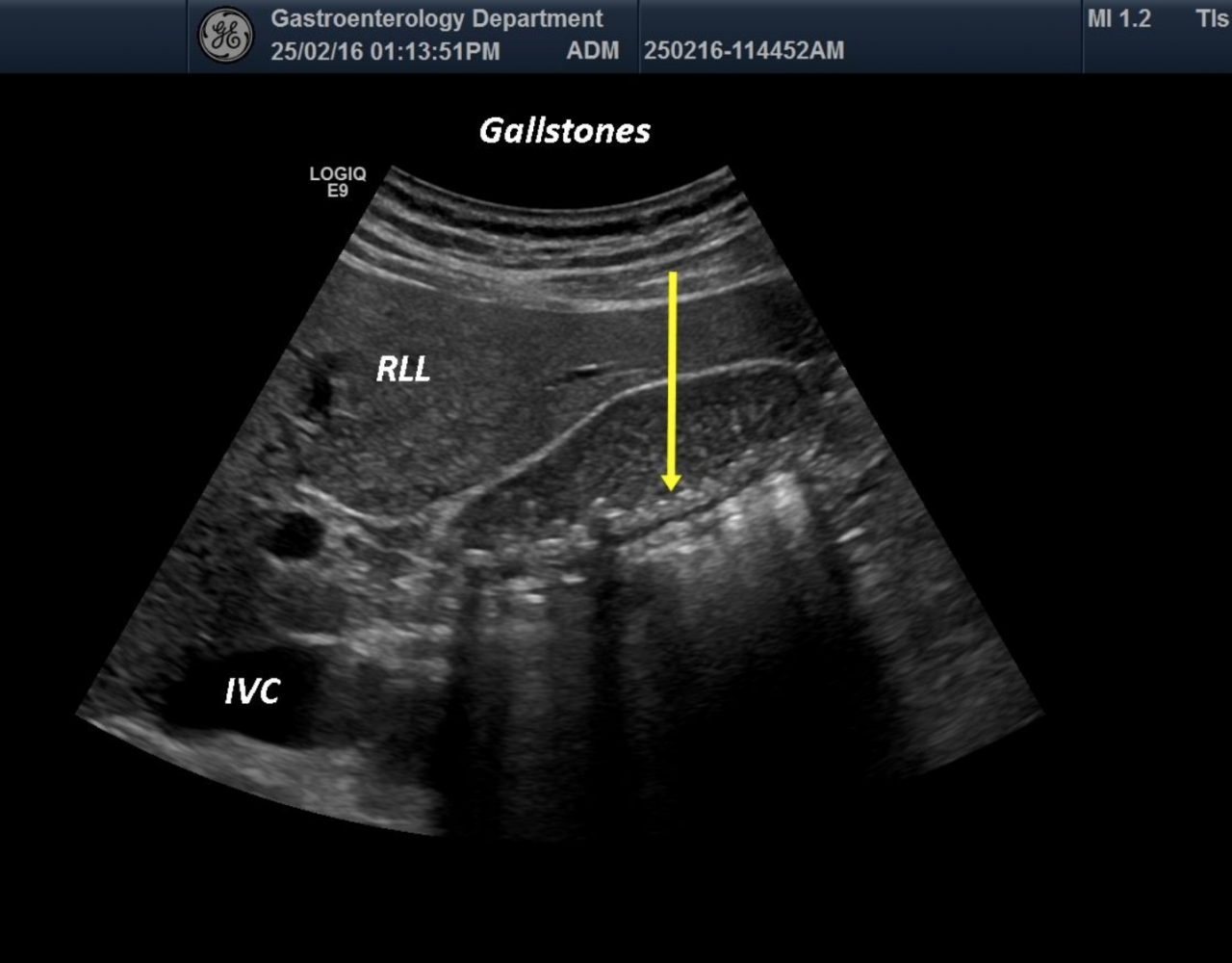 Gallstones and Sludge in Gallbladder – EFSUMB