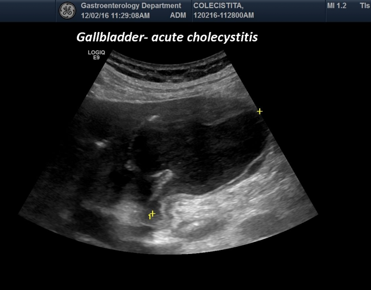 Acute Cholecystitis – EFSUMB