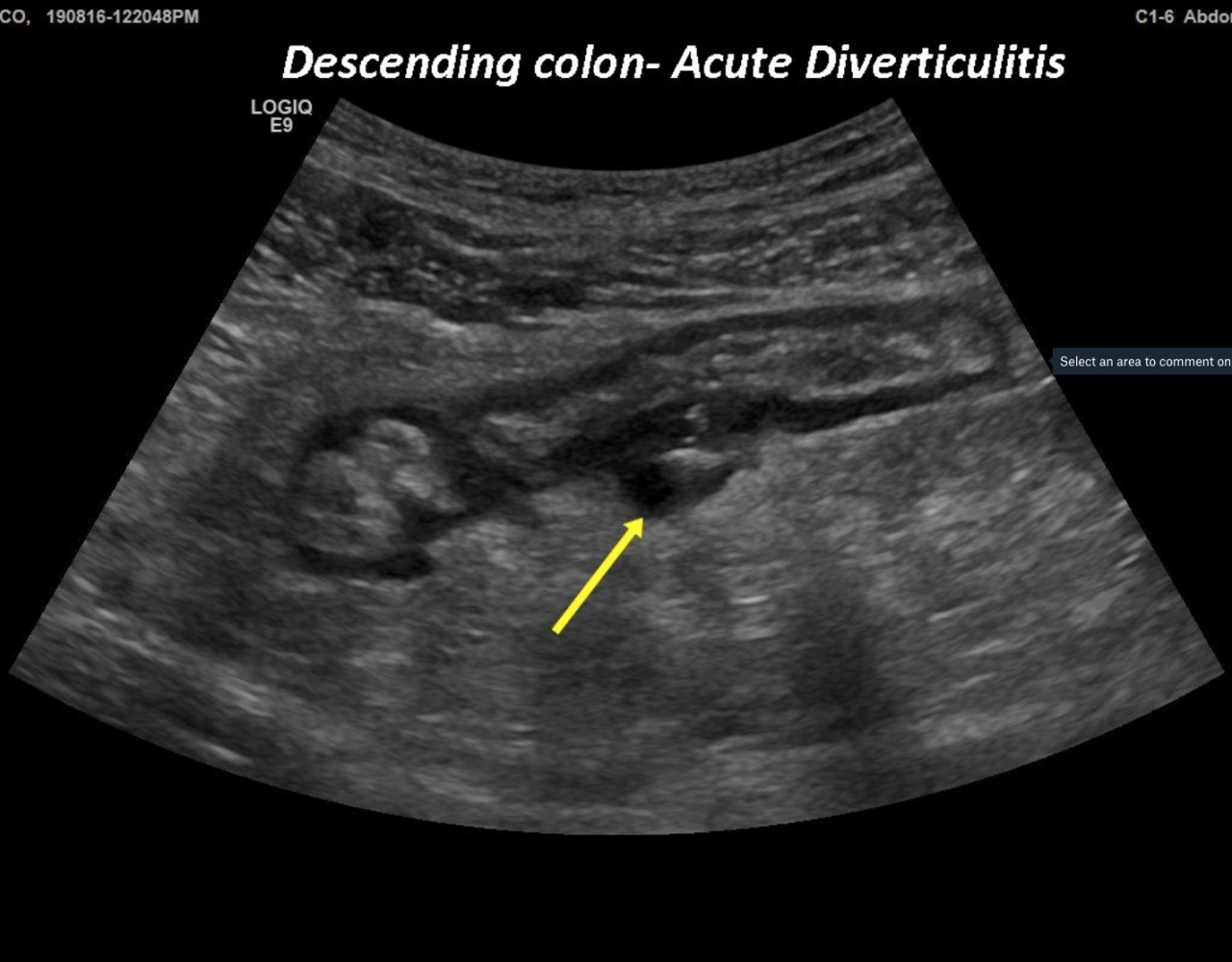 Diverticulitis – EFSUMB