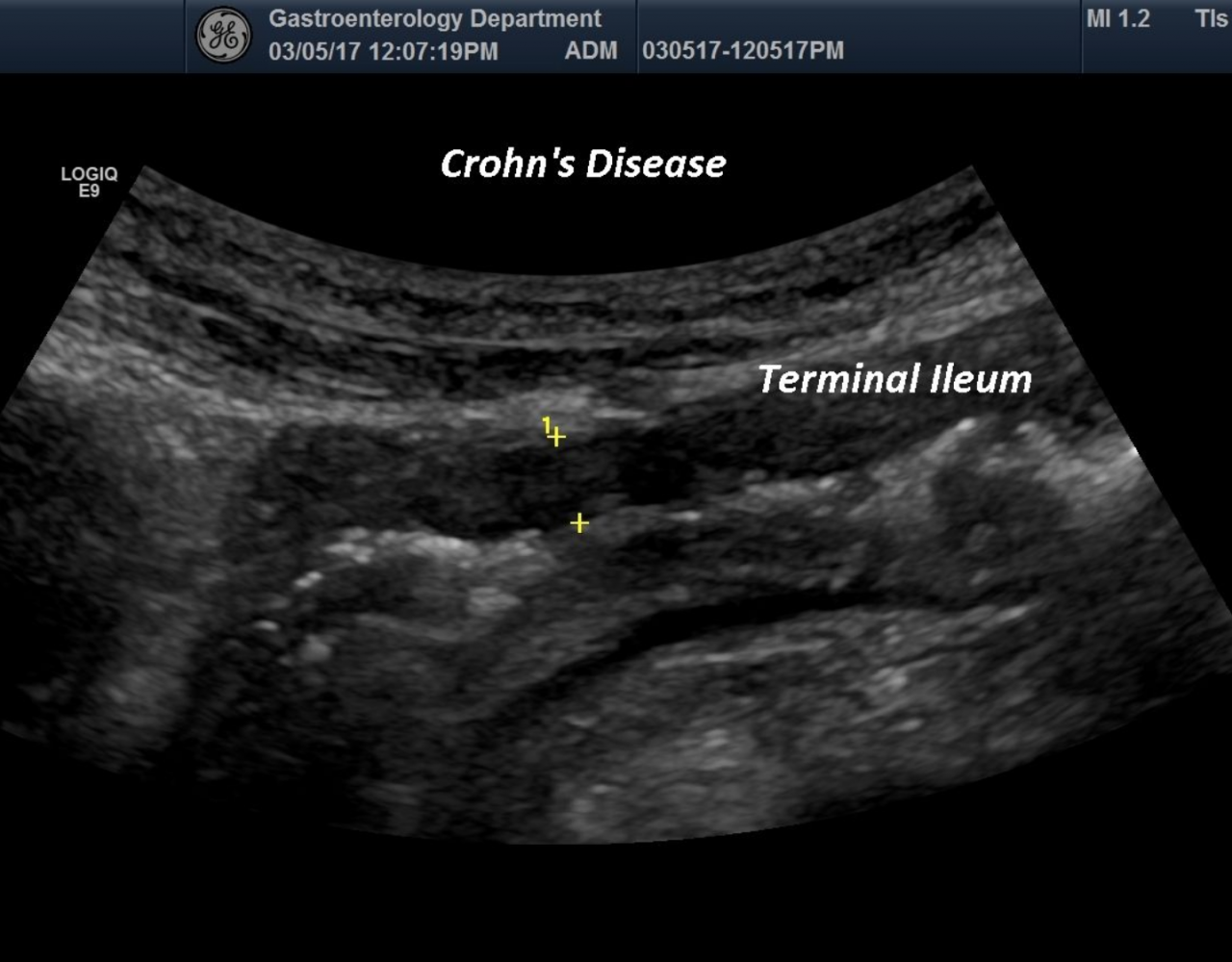 Crohn’s Disease – EFSUMB