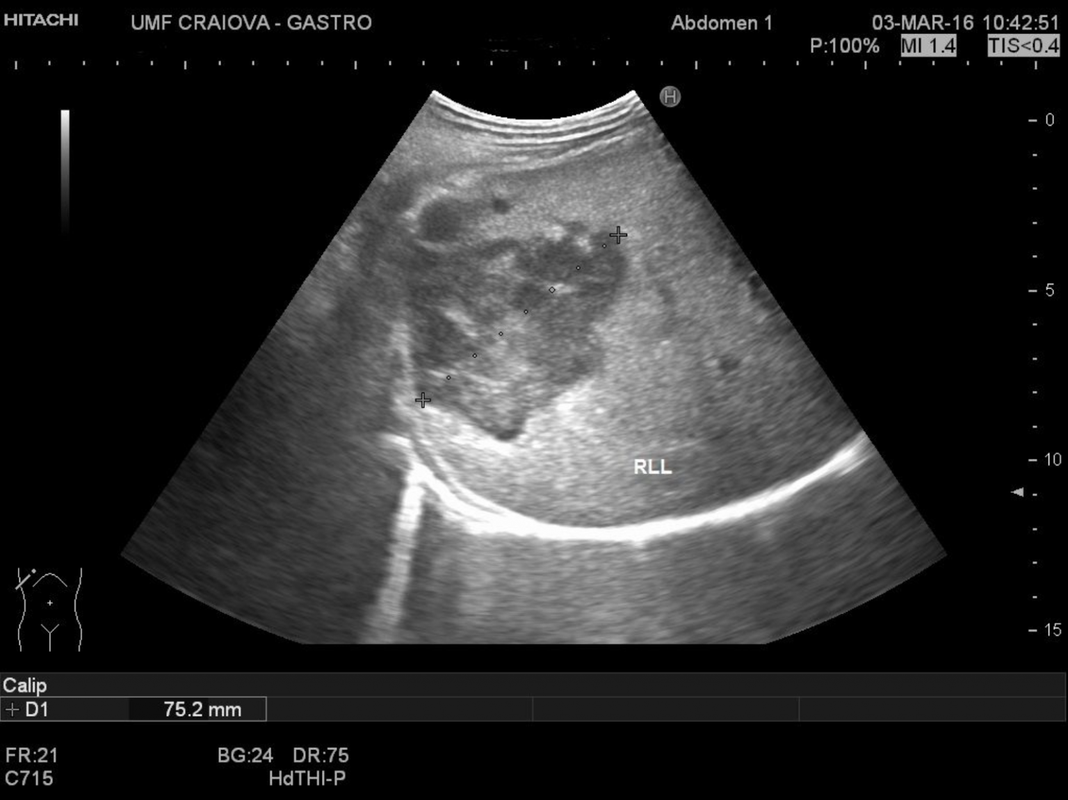 Hepatocellular carcinoma 02 [2 images] – EFSUMB