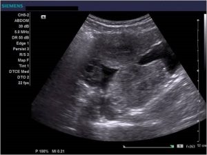 The ultrasound diagnosis of ovarian torsion [May 2021] – EFSUMB
