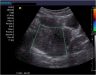 The ultrasound diagnosis of ovarian torsion [May 2021] – EFSUMB