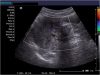 The ultrasound diagnosis of ovarian torsion [May 2021] – EFSUMB