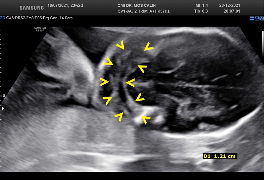 Typical ultrasound features in open spina bifida [January 2022] – EFSUMB