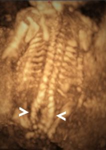 Typical ultrasound features in open spina bifida [January 2022] – EFSUMB