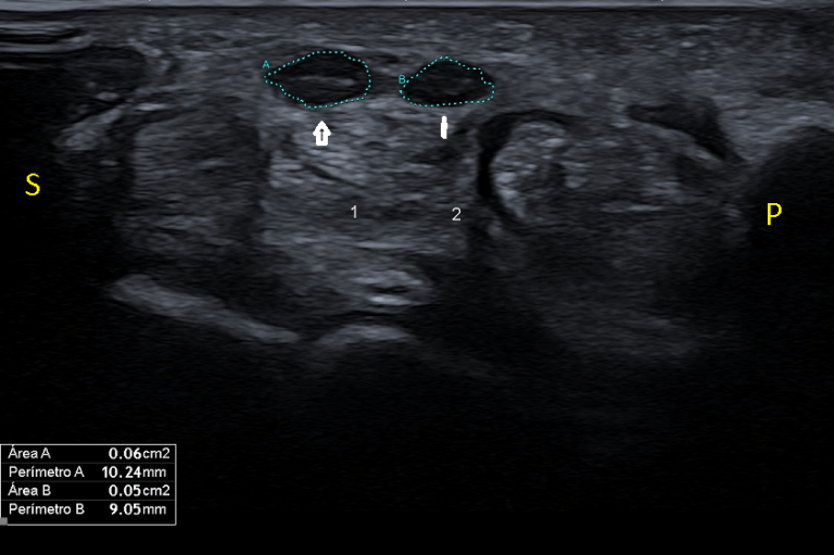 Bifid median nerve with persistent median artery in carpal tunnel ...