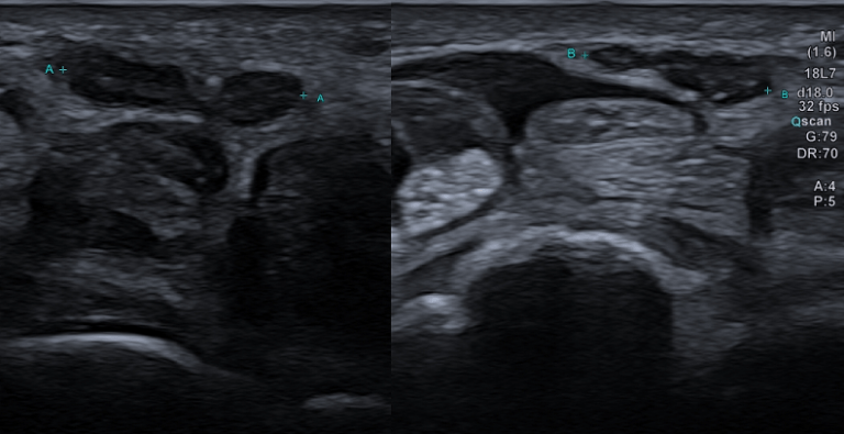 Bifid median nerve with persistent median artery in carpal tunnel ...