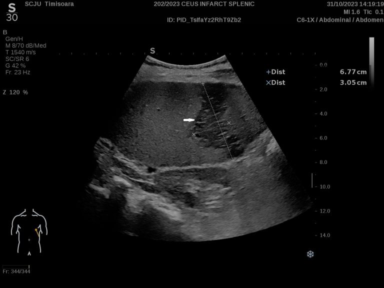 Splenic Infarction: An Ultrasonographic Diagnosis [MARCH 2025] – EFSUMB