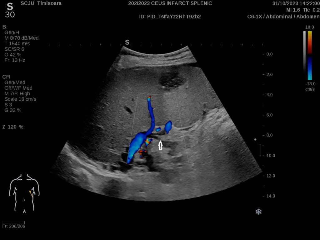 Splenic Infarction: An Ultrasonographic Diagnosis [MARCH 2025] – EFSUMB