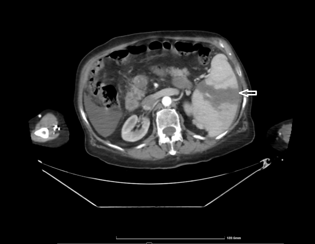 Splenic Infarction: An Ultrasonographic Diagnosis [MARCH 2025] – EFSUMB